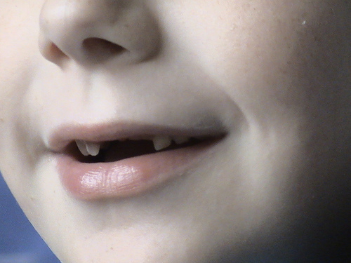 Early Missing Teeth And Speech Development Marshalla Speech Language