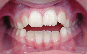 Lisp Remediation With Anterior Open Bite - Marshalla Speech & Language