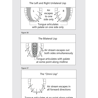 Frontal Lisp, Lateral Lisp: Procedures for Diagnosis and Treatment ...