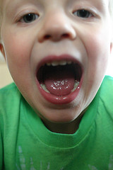 Incisor Grinding - Marshalla Speech & Language